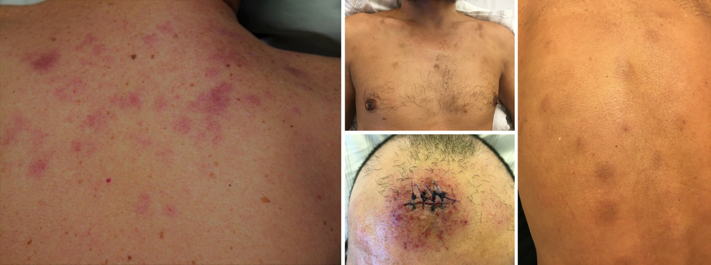 Blastische plasmazytoide dendritische Zellneoplasie (BPDCN) — Onkopedia