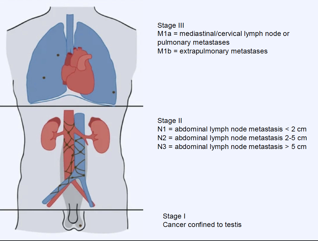 Testicular Cancer (male germ cell tumors) — Onkopedia